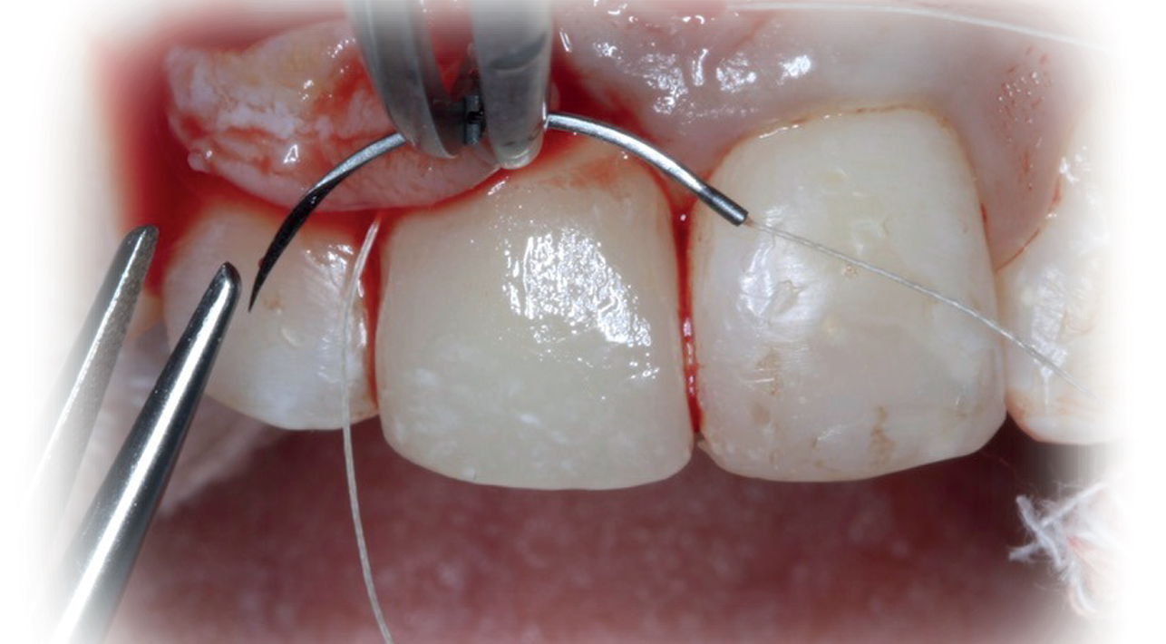 CPD :: CME :: PERIODONTAL FLAPS & SUTURING TECHNIQUES & PRINCIPLES