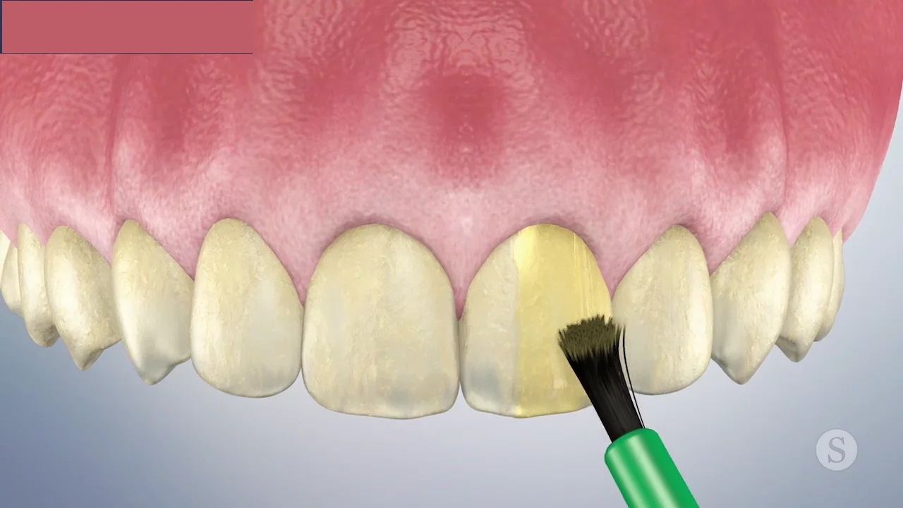 DENTAL :: CEMENTS AND LINERS :: VARNISH