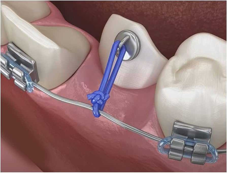 DENTAL :: ORTHODONTICS :: ELASTIC THREAD