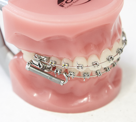 DENTAL :: ORTHODONTICS :: SPRINGS