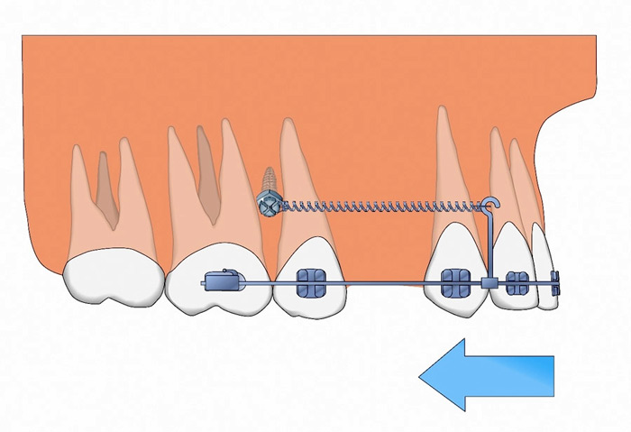 DENTAL :: ORTHODONTICS :: ORTHO SCREWS AND MINI IMPLANTS